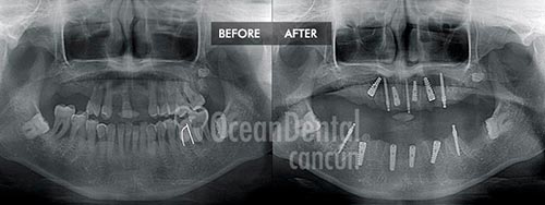 Ocean Dental Cancun - Homepage - Book Direct With Clinic