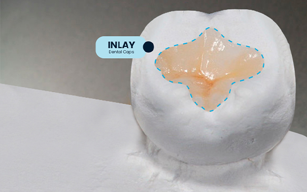Root Canal・Inlay/Onlay・Bone Graft [Mexico Full Guide | 2022]
